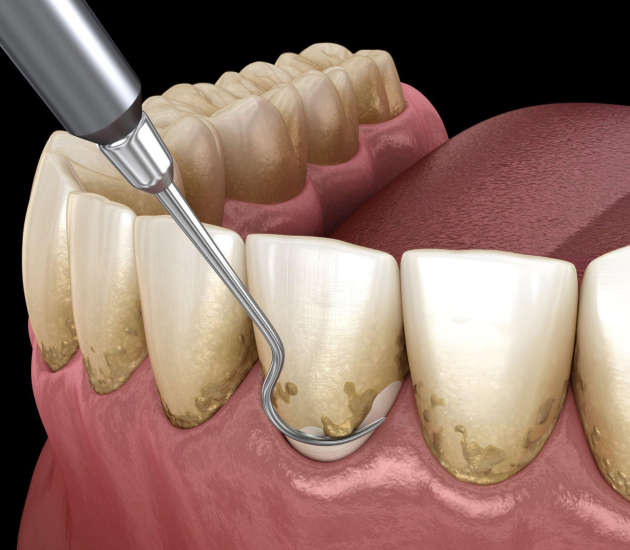 Deep Teeth Cleaning | Inspired Smiles Family Dental