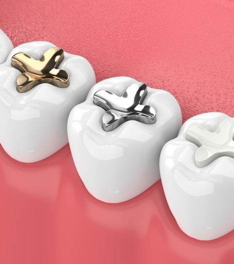 Amalgam Tooth Fillings | Inspired Smiles Family Dental